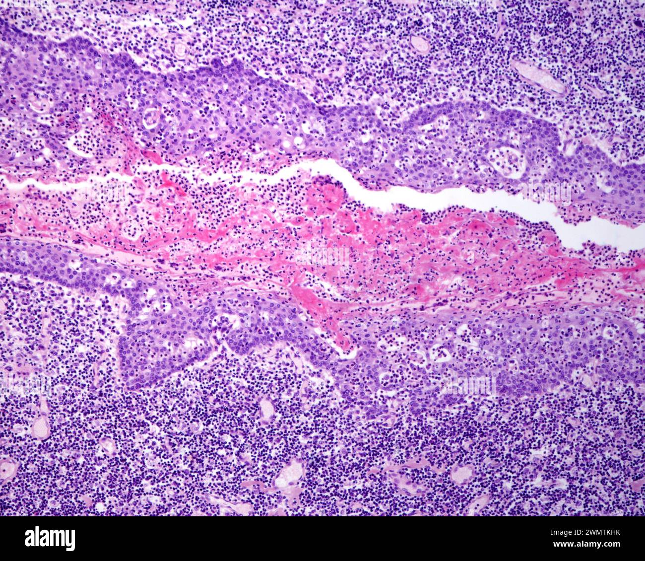 Human palatine tonsil crypt, light micrograph Stock Photo - Alamy