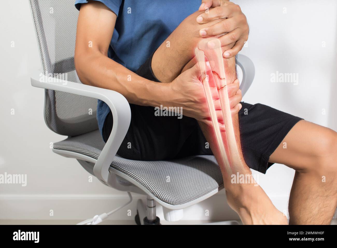 Shin bone break hi-res stock photography and images - Alamy