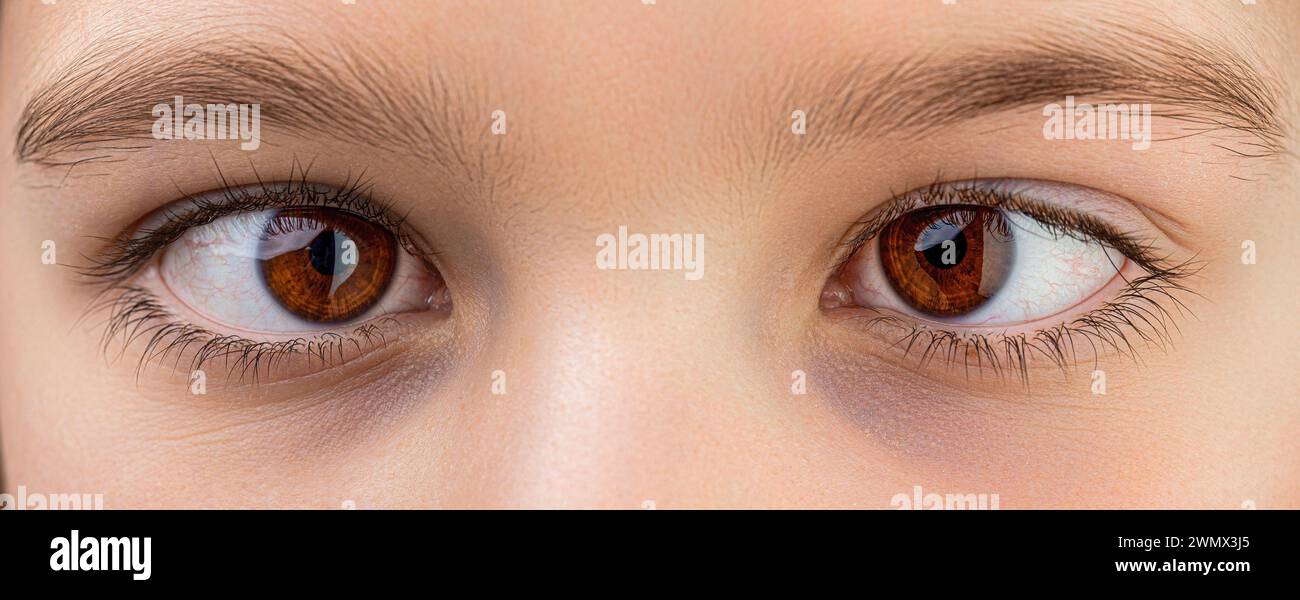 Strabismus. Little patient strabismus, treatment ophthalmic diseases ...