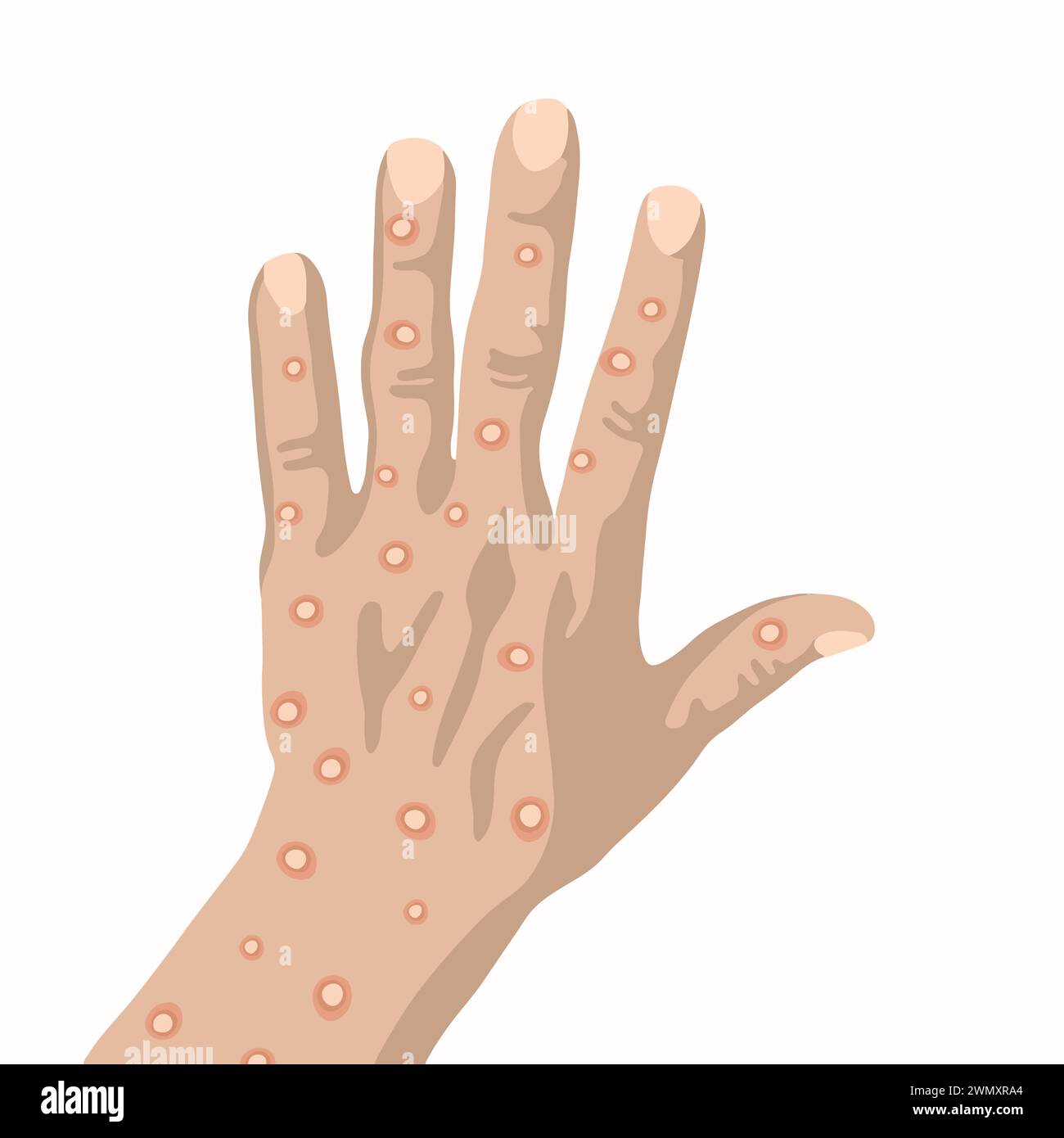 Smallpox rash Stock Vector Images - Alamy