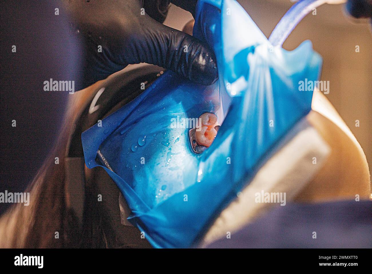 dentist removes the rubber dam after treatment and restoration of the ...