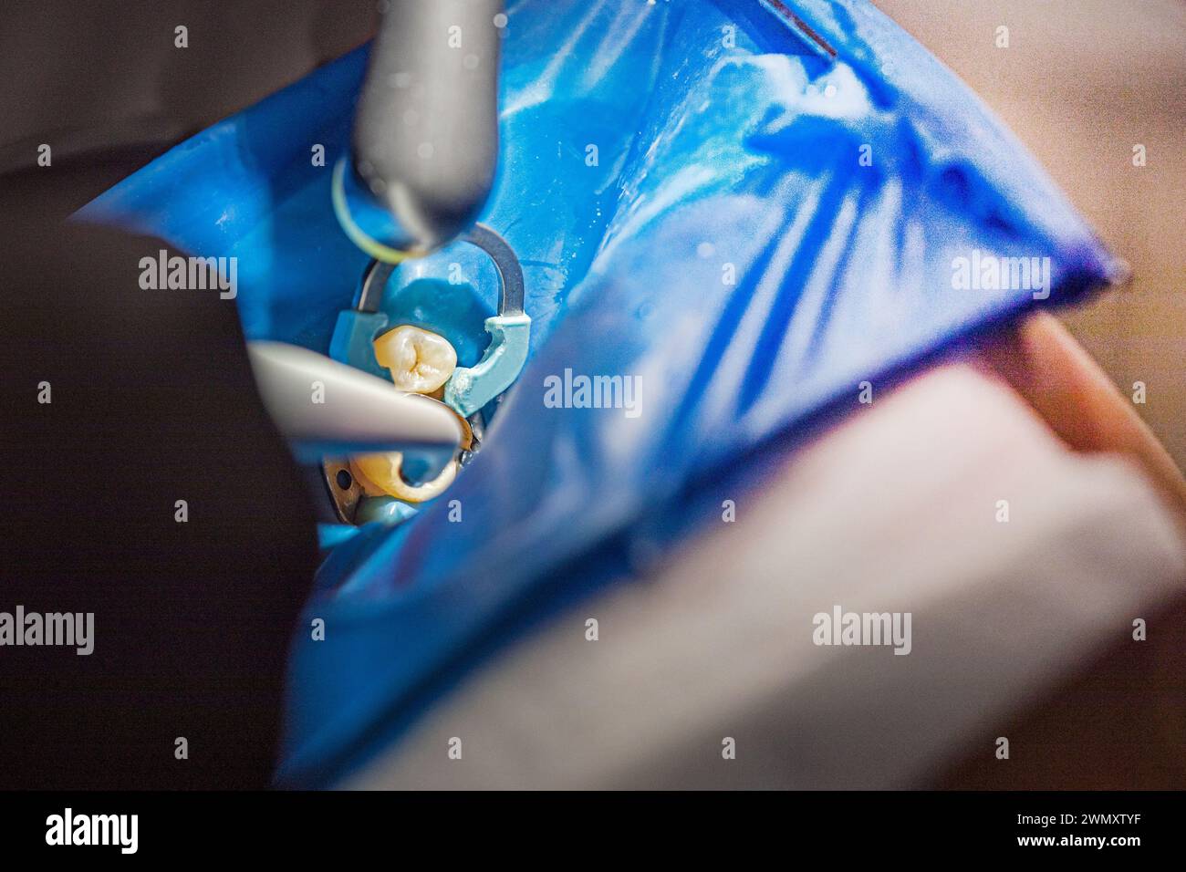 dentist inserts a dental instrument between the patient's teeth. Dental ...