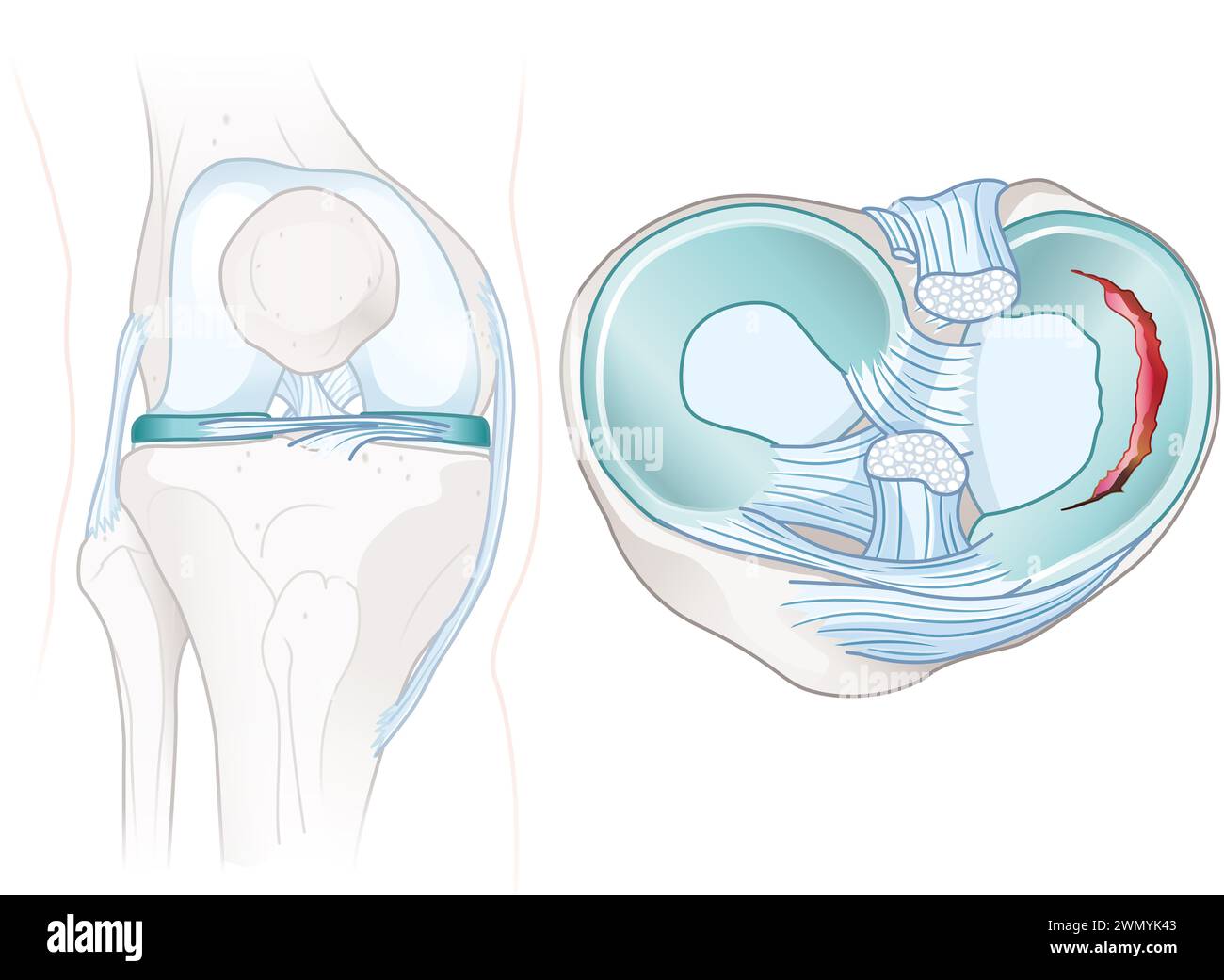 Menisci are C-shaped cartilage in knees, cushioning and stabilizing ...