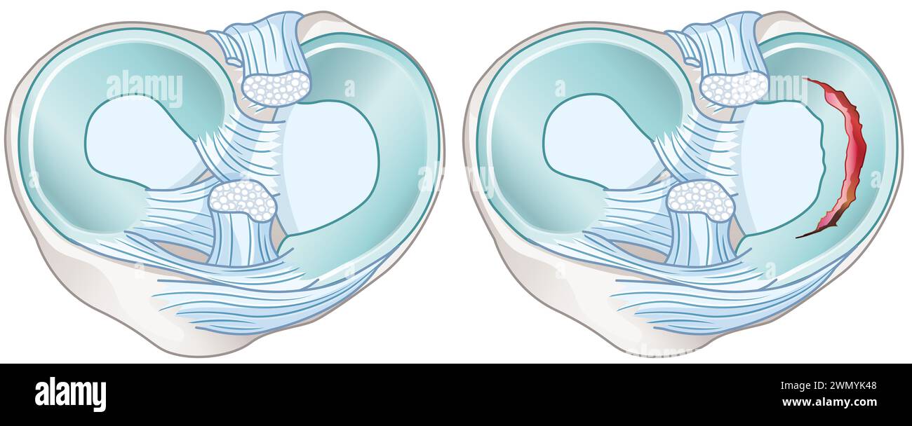 Meniscal repair hi-res stock photography and images - Alamy