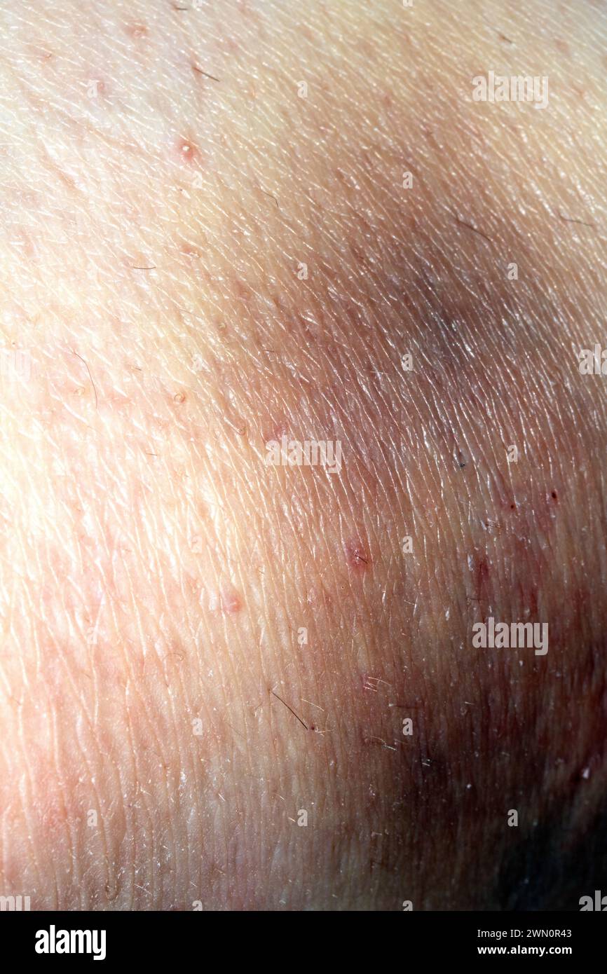 A Close Up of a Big Bruise on a Body Part Knee From Tripping UP and ...