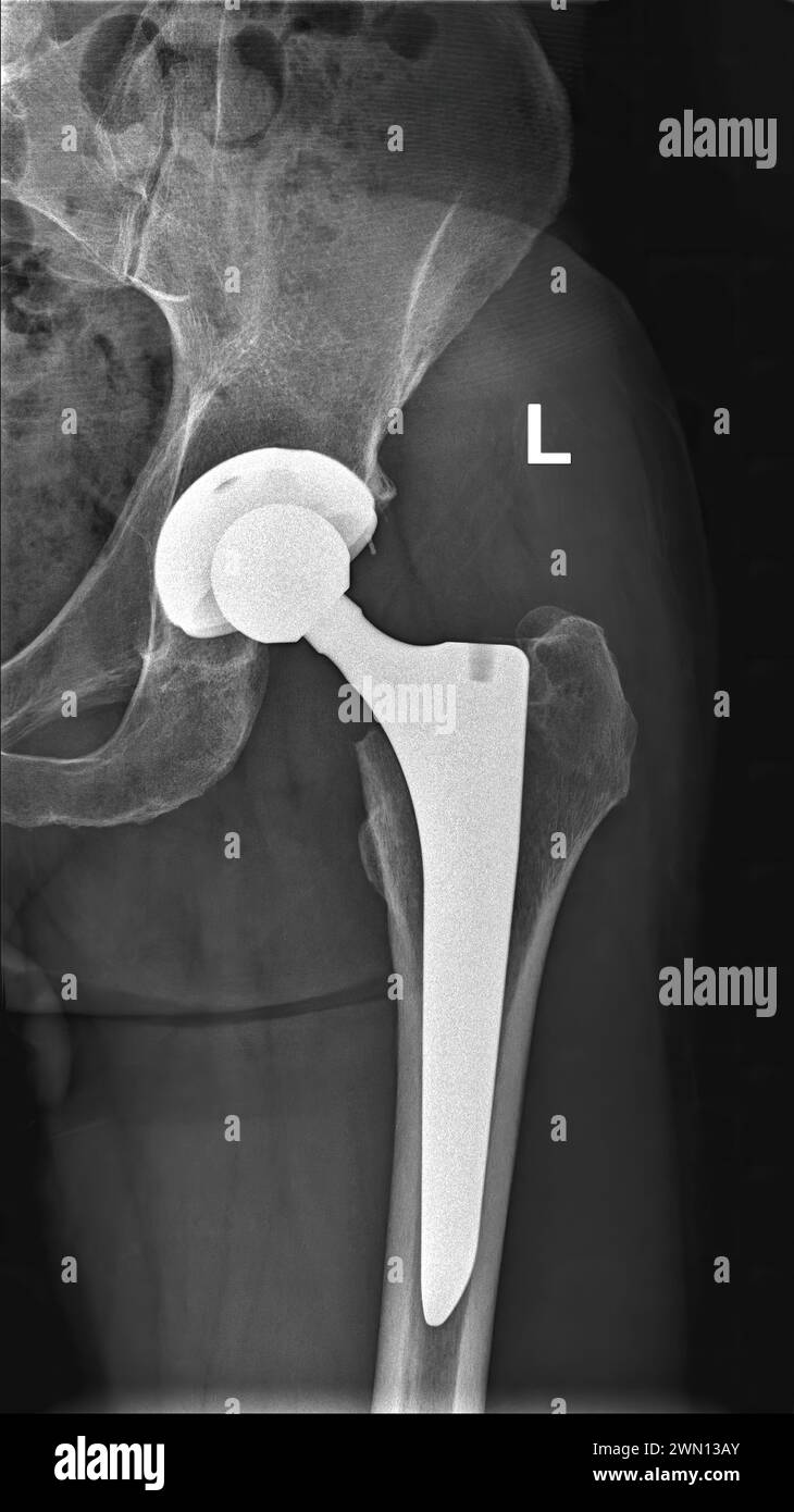X-ray of left hip prosthesis. AP view. 12 weeks after total hip ...