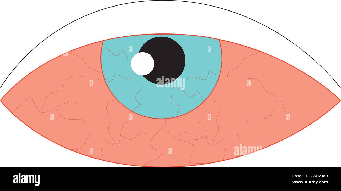 Sore eye vector vectors hi-res stock photography and images - Alamy