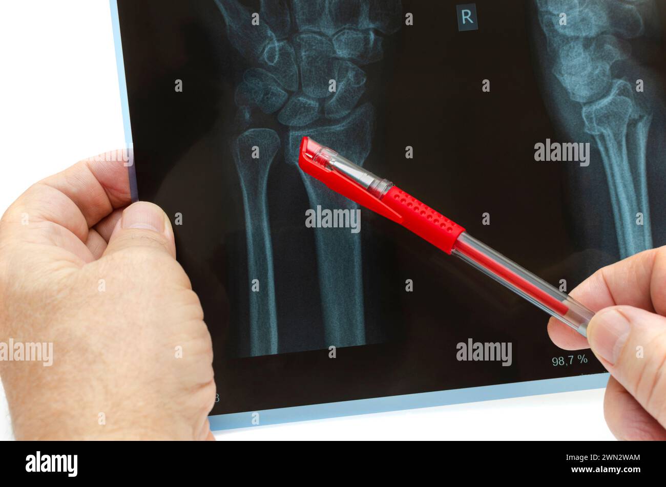 Fracture arm x ray hi-res stock photography and images - Alamy