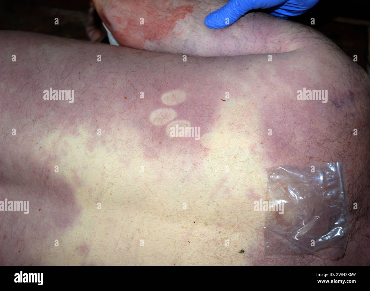 Livor hi-res stock photography and images - Alamy