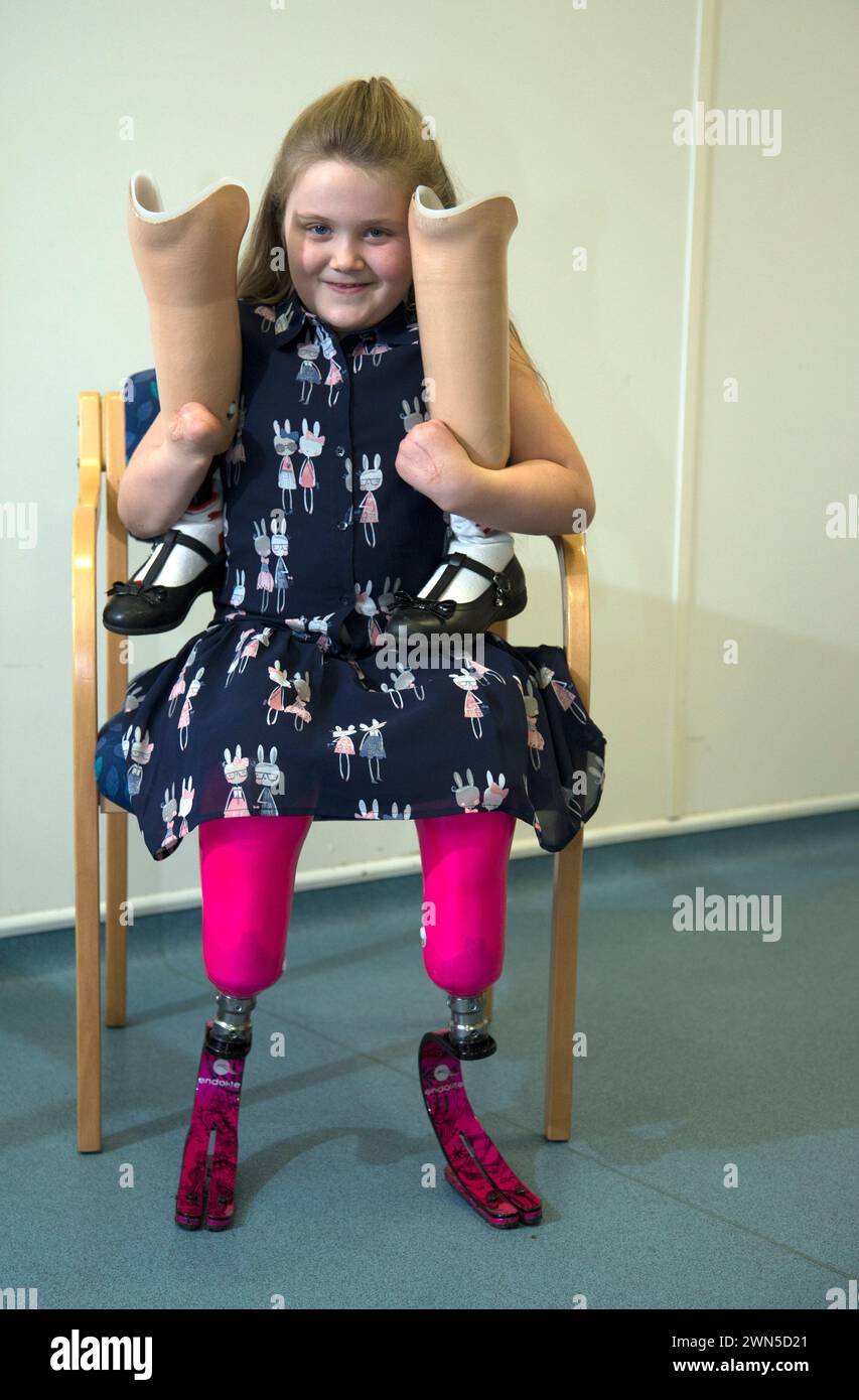 17/12/14 Grace with her old legs and new blades. After losing her legs ...
