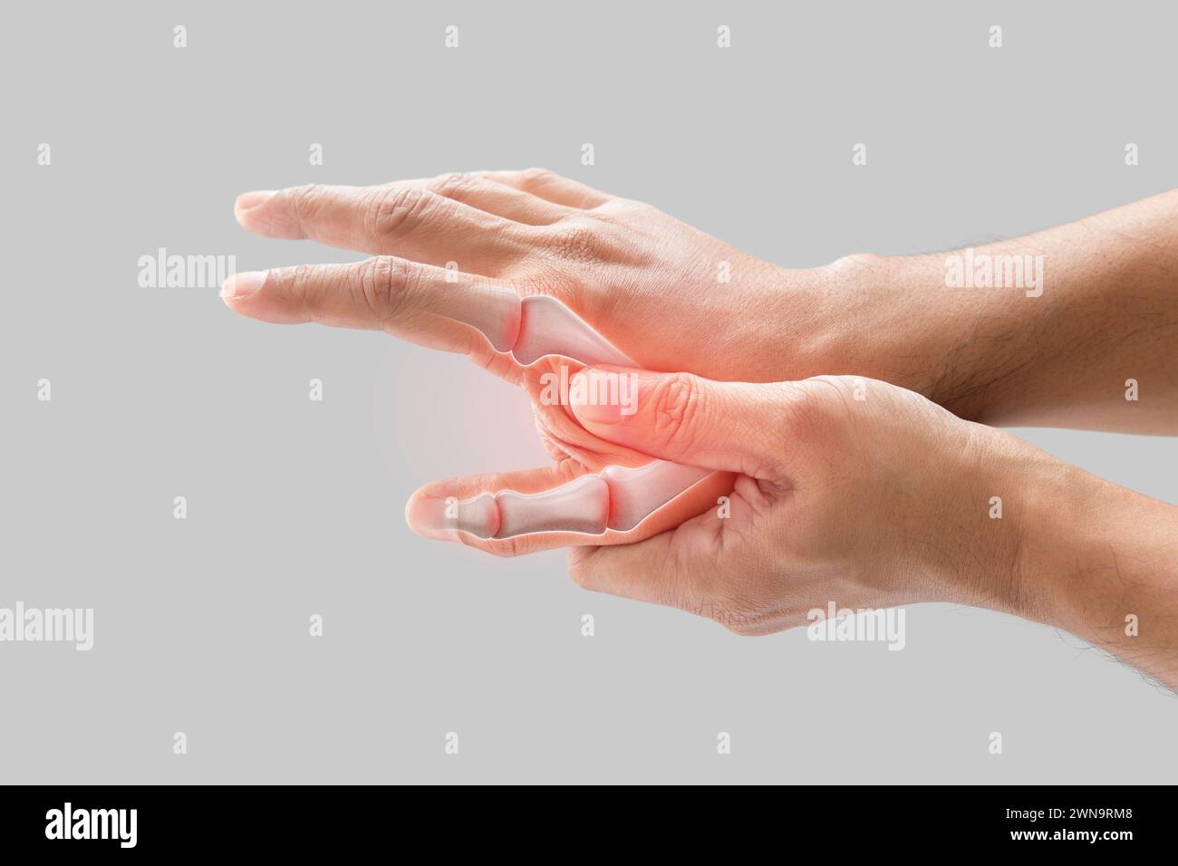 A man has a sore palm because of inflammation of the finger bone Stock ...