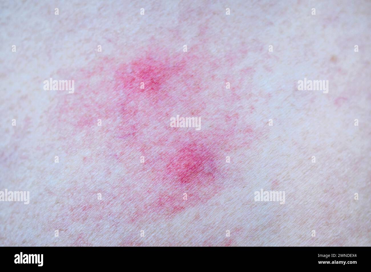 Skin allergy from mosquito bites Stock Photo - Alamy