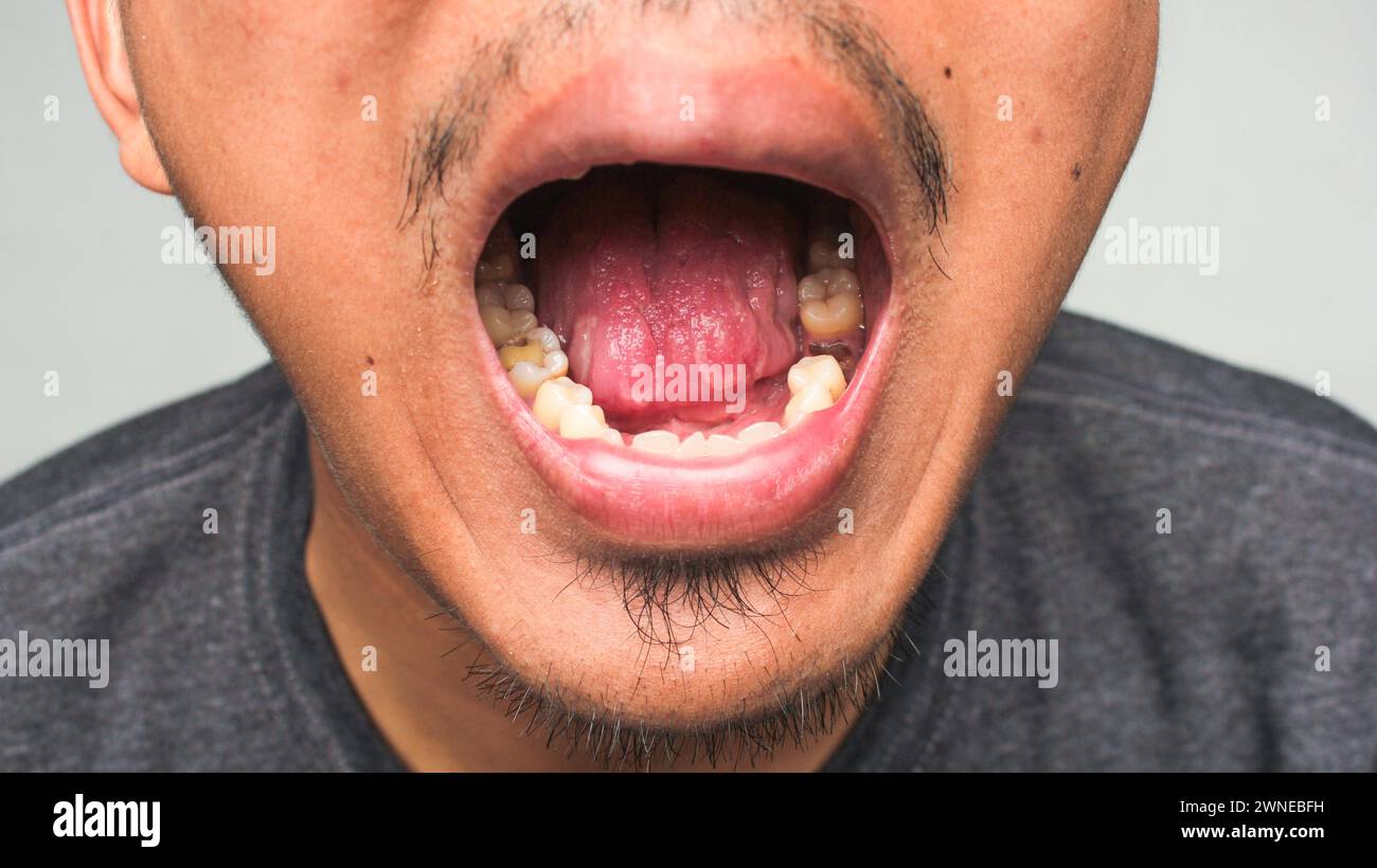 Damaged tooth with cavity dental caries decay Stock Photo - Alamy