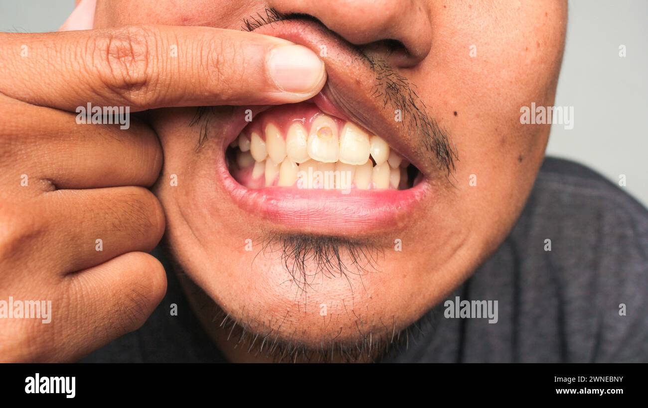 Damaged tooth with cavity dental caries decay Stock Photo - Alamy
