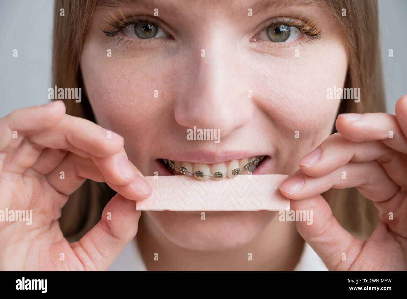 Young woman with metal braces on her teeth is chewing gum. The girl is ...