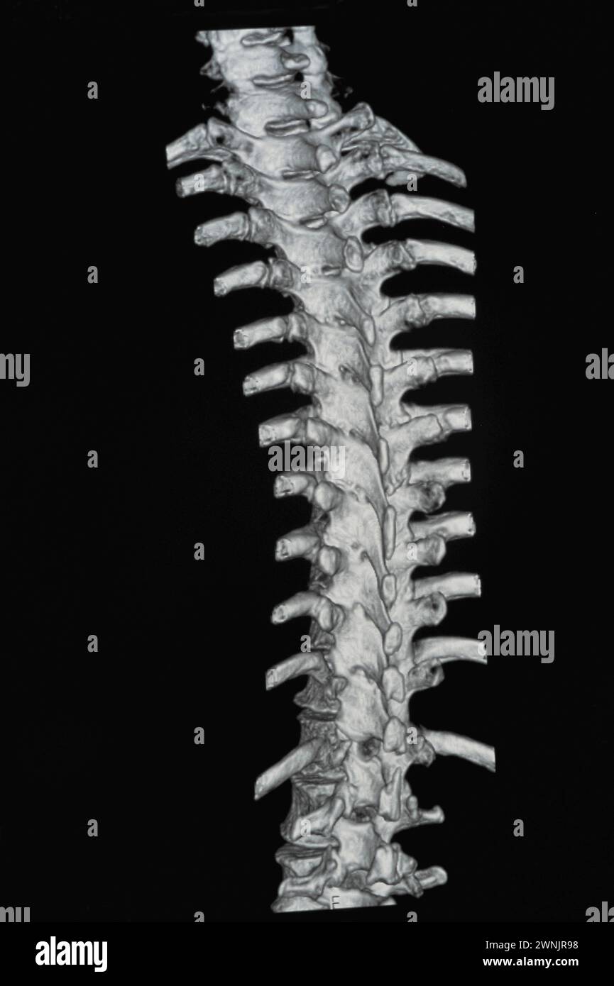 Ct of the cervical spine hi-res stock photography and images - Alamy