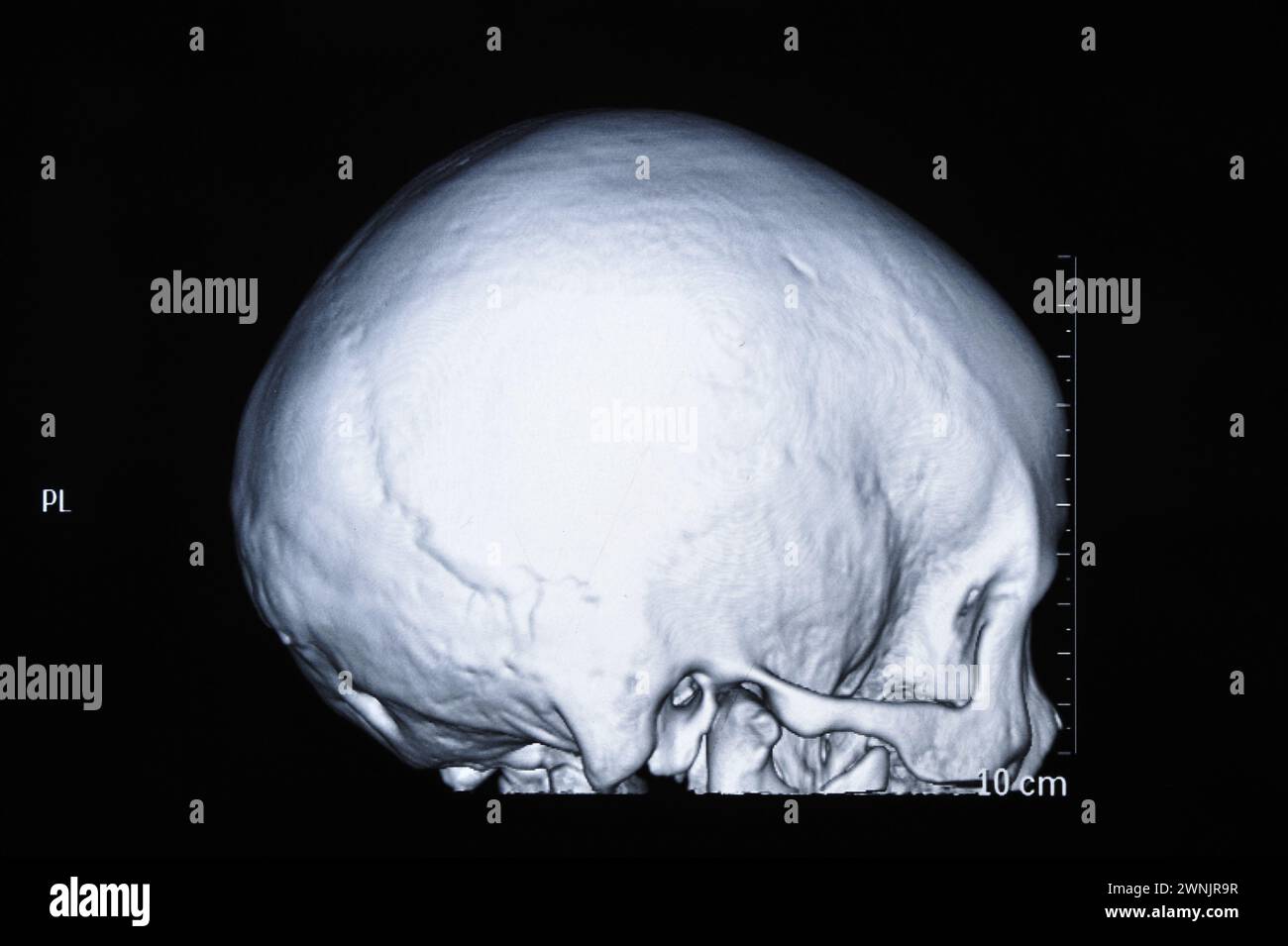 Human skull CT scans Stock Photo - Alamy