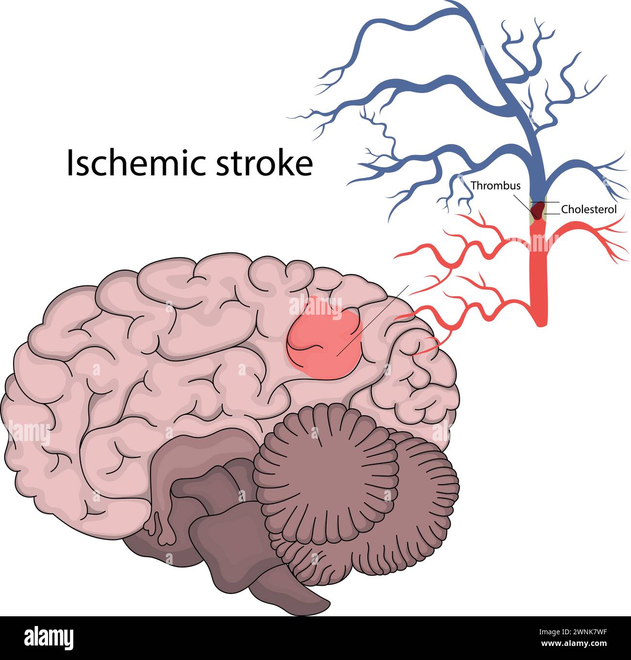 Vector illustration of ischemic stroke. Brain infarction. Blockage of a ...