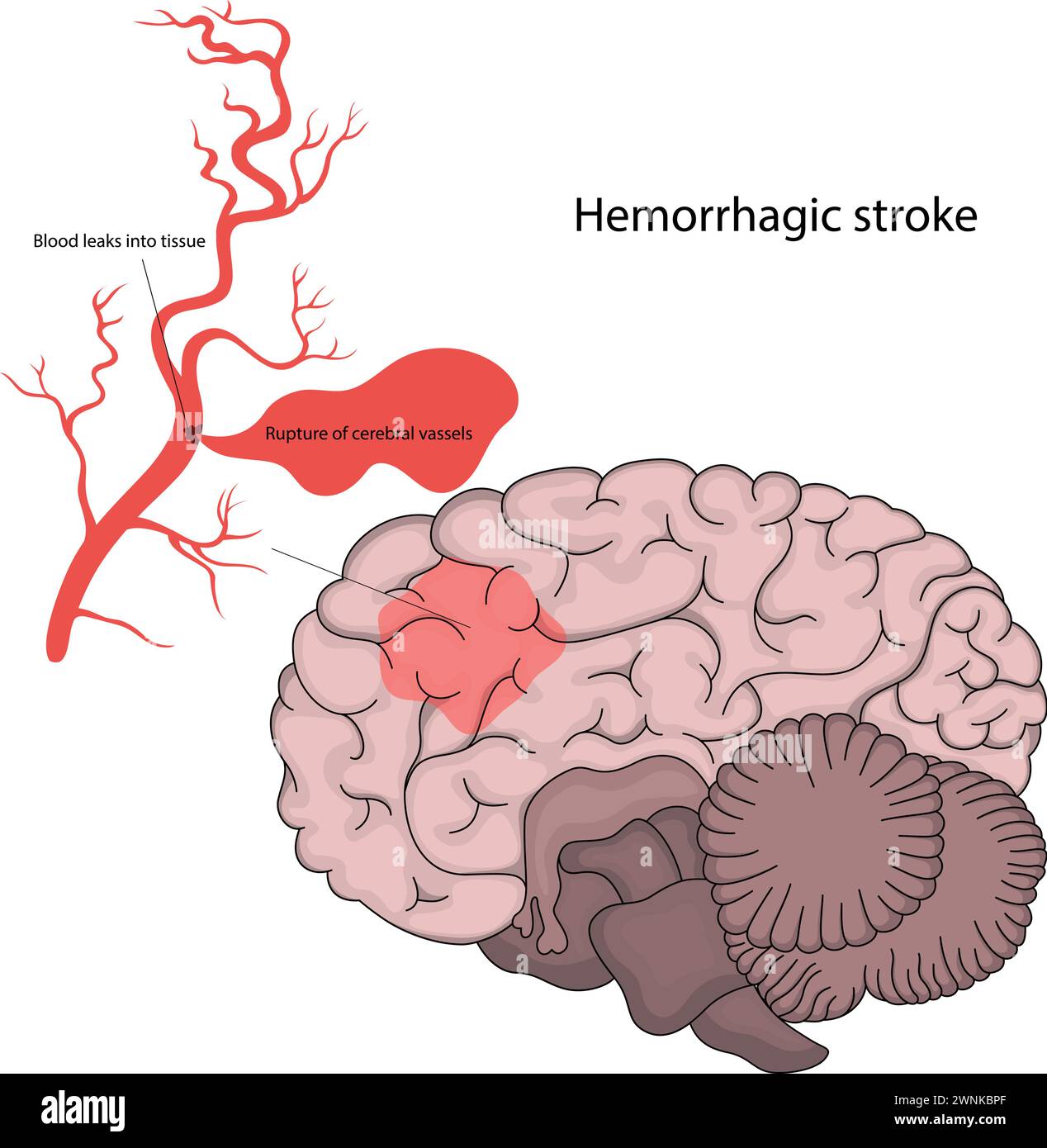 Ischemic stroke in the cerebral artery hi-res stock photography and ...