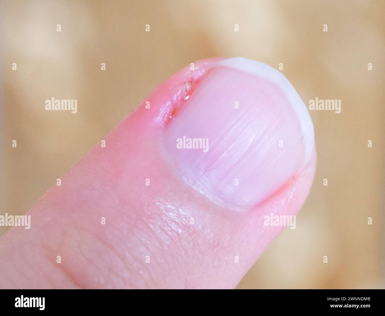 Wound healing hi-res stock photography and images - Alamy