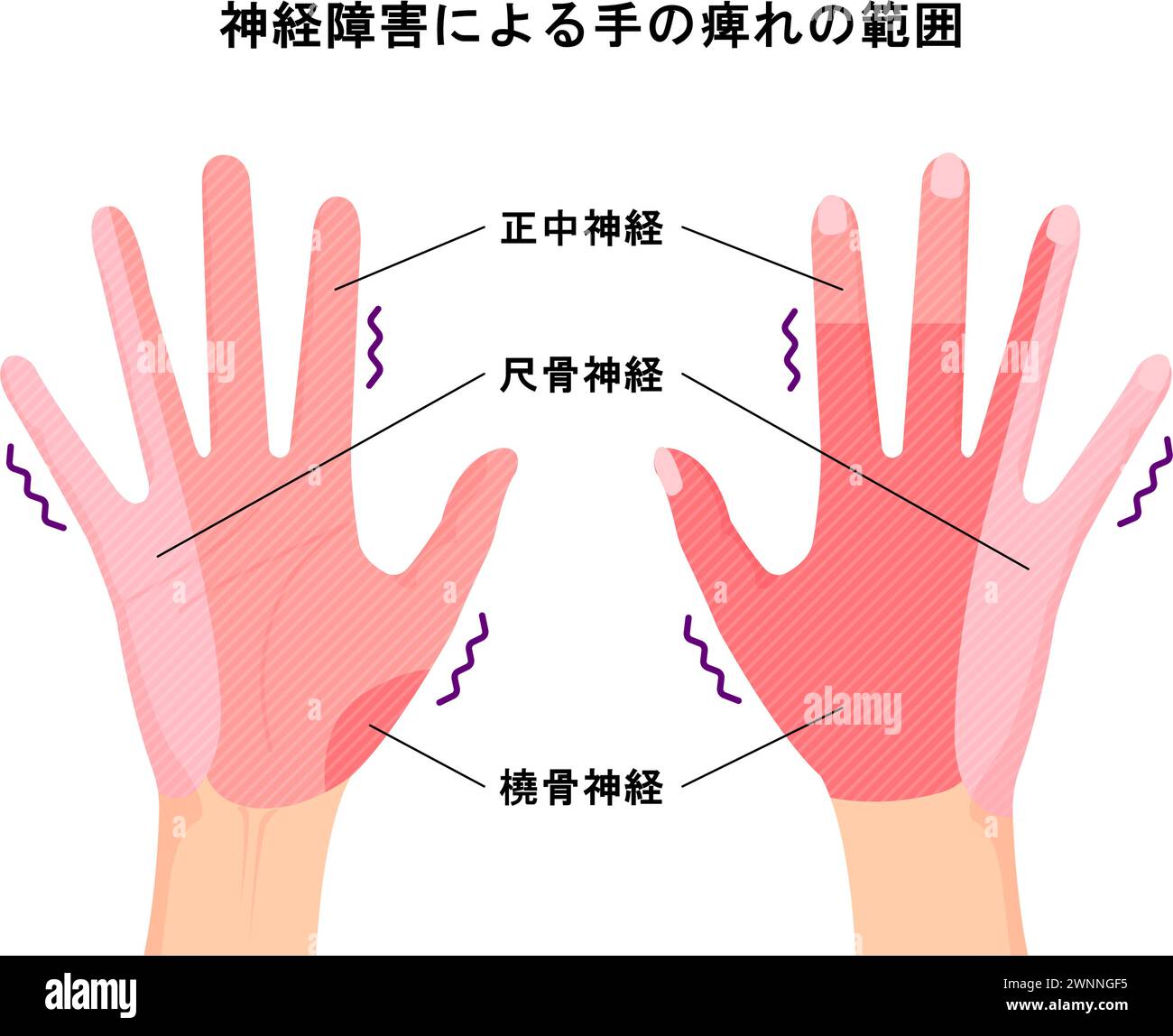 Neurological illness hi-res stock photography and images - Alamy