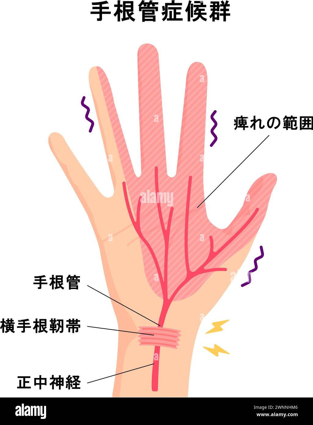 Carpal Tunnel Syndrome Vector Illustration Stock Vector Image And Art Alamy 5634
