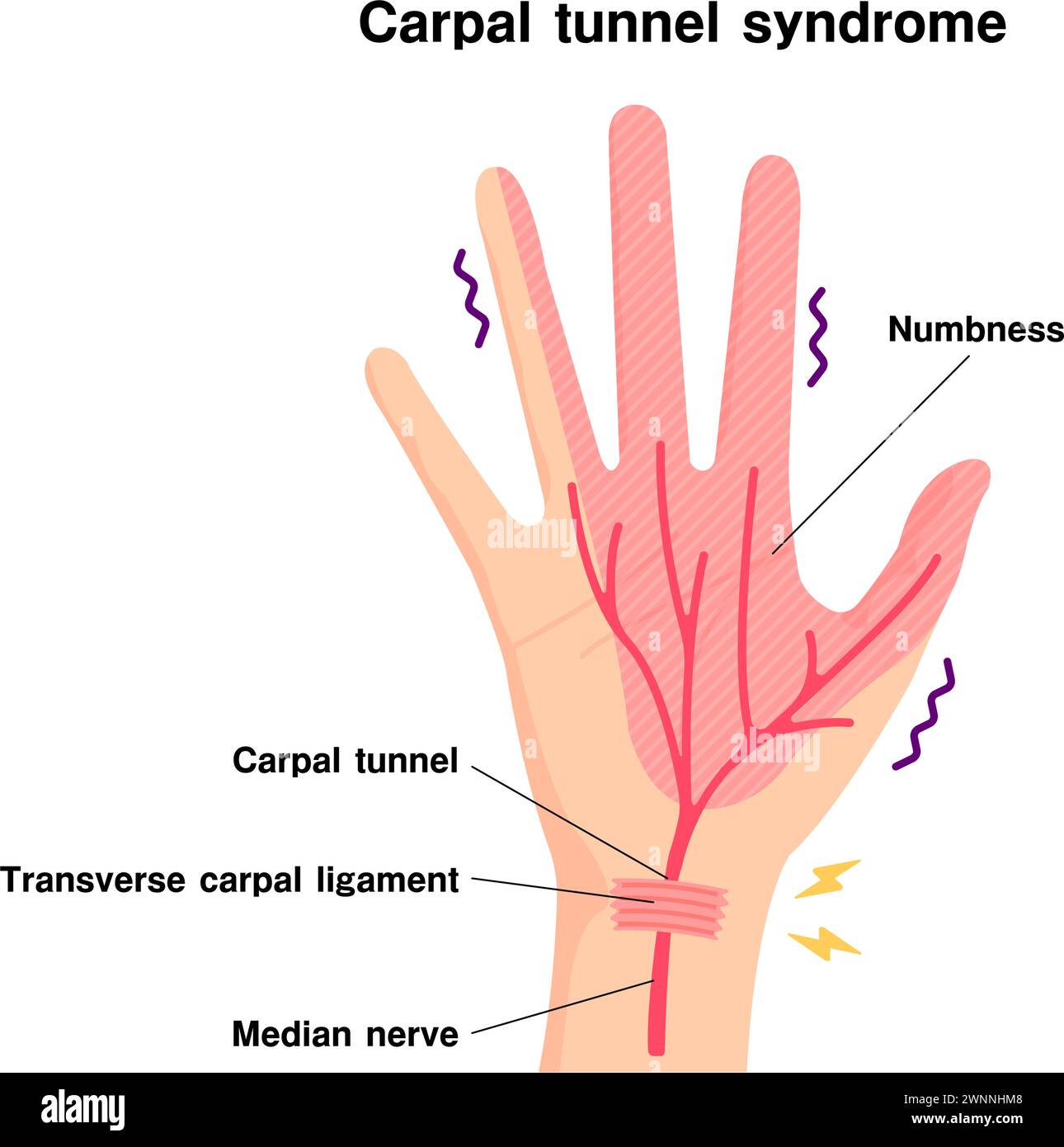 Carpal tunnel syndrome vector illustration Stock Vector Image & Art - Alamy