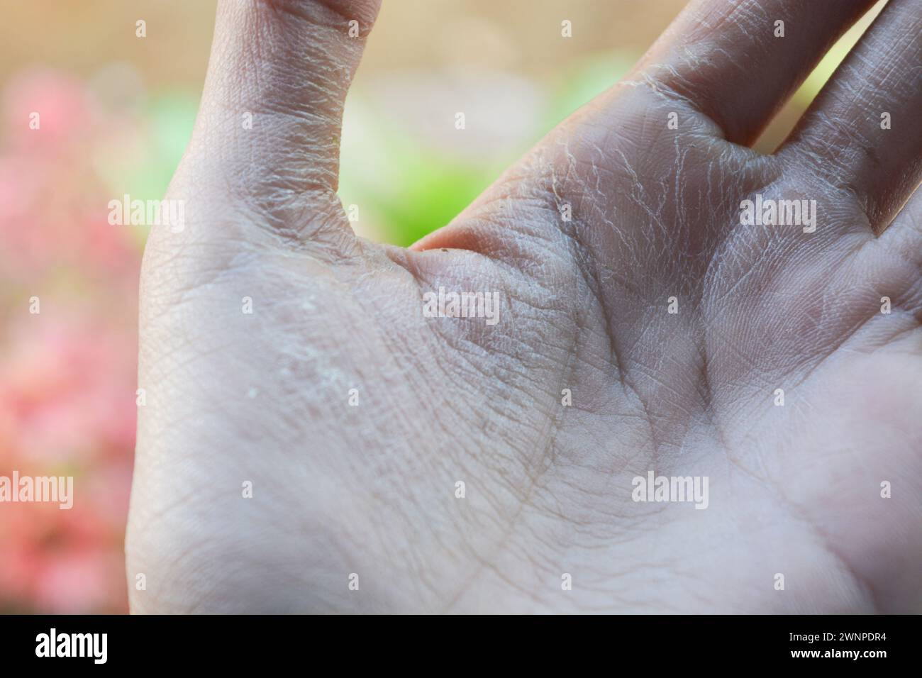 Close up photo of sore fingers Stock Photo - Alamy