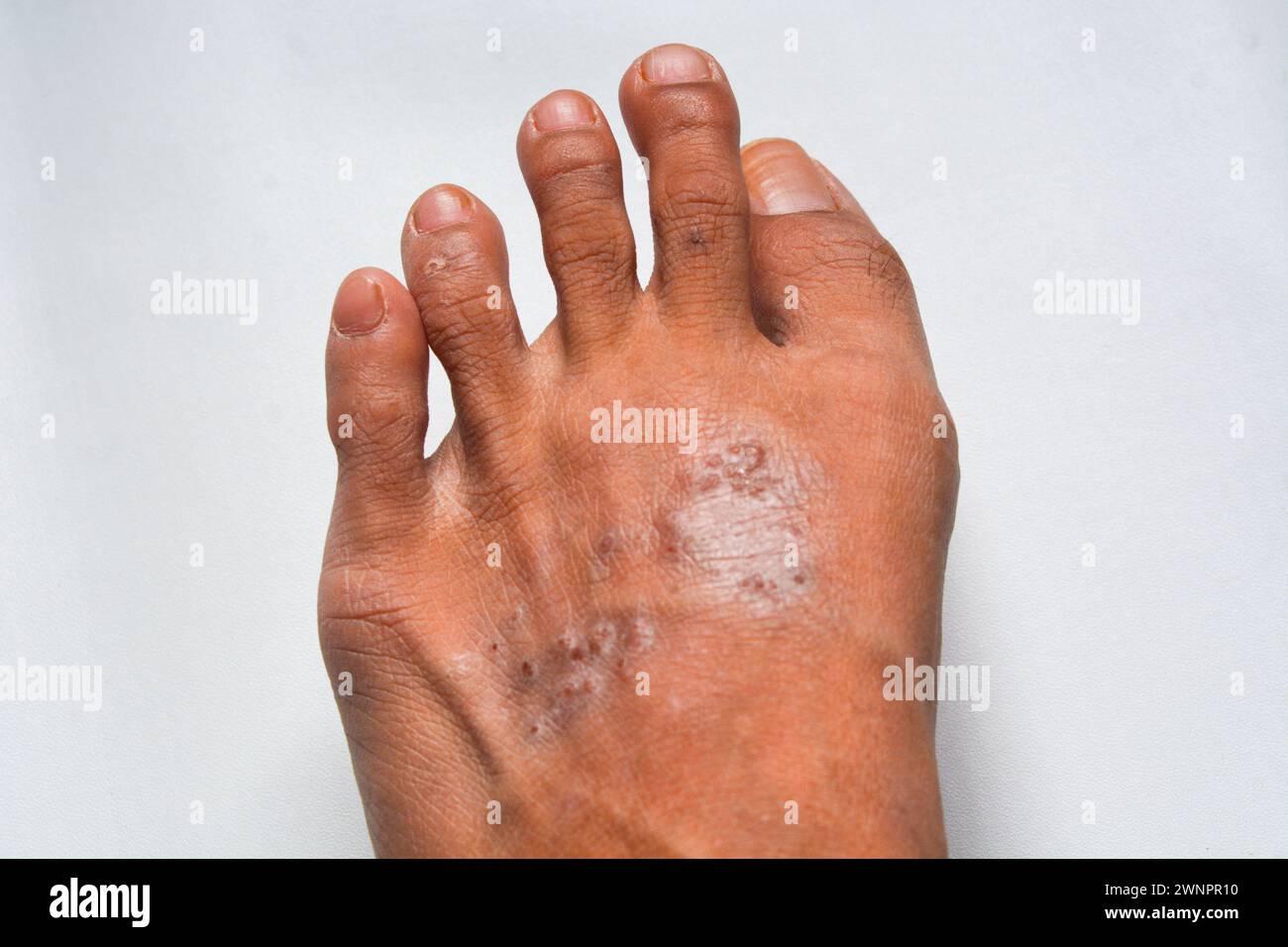 Close up photo of itchy and sore leg area, photo about health Stock ...