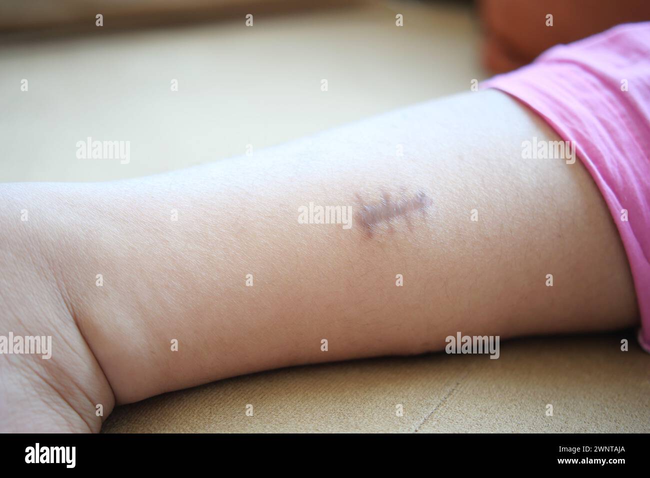 Stitched wound mark on a child foot Stock Photo - Alamy