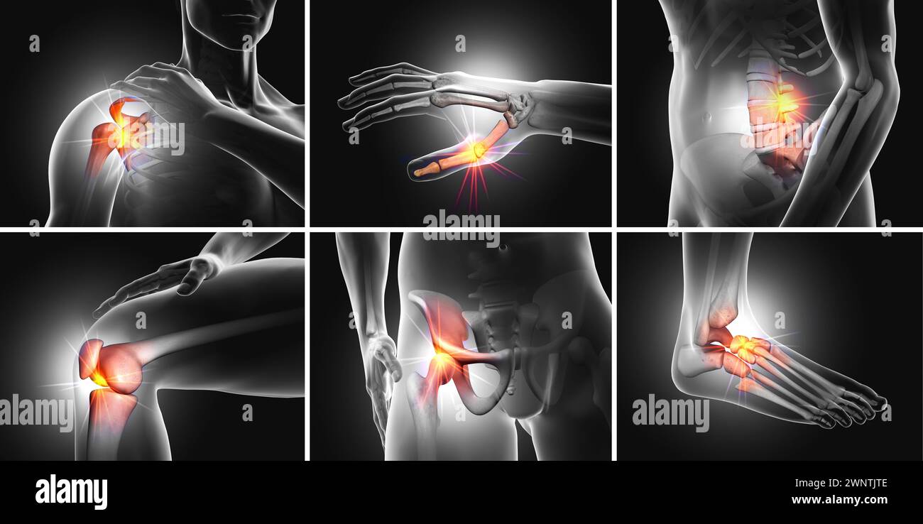 A set of six painful joints, medical 3D illustration Stock Photo - Alamy