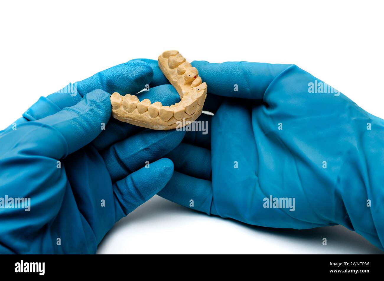 Dentist holding a cast of teeth in medical gloves for making dentures ...