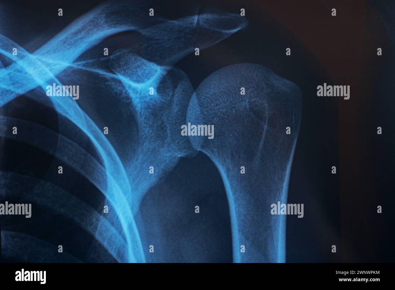 Normal shoulder x ray hi-res stock photography and images - Alamy