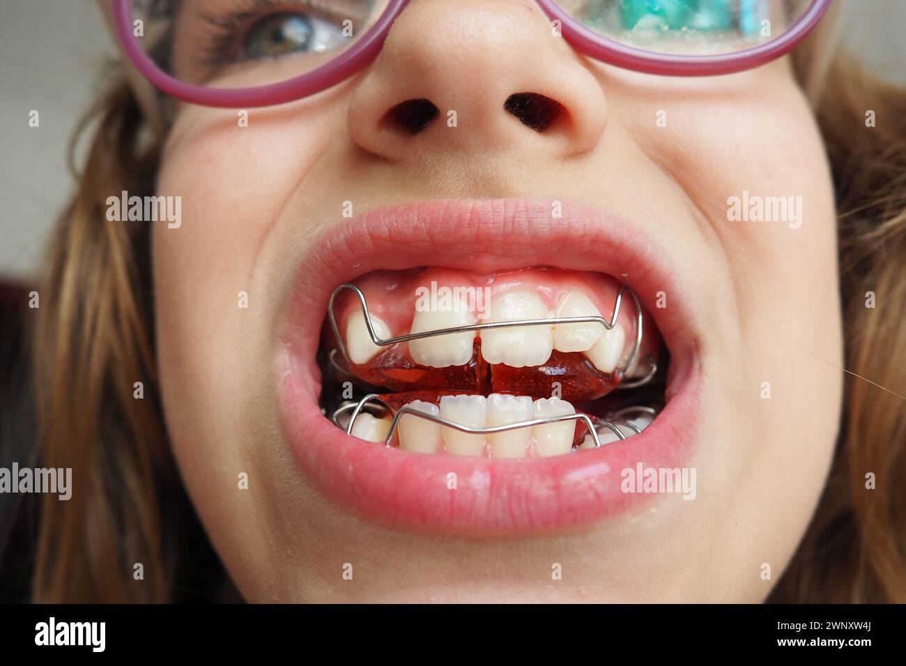 Childrens orthodontic prosthesis. Metal-plastic prostheses on the jaws ...