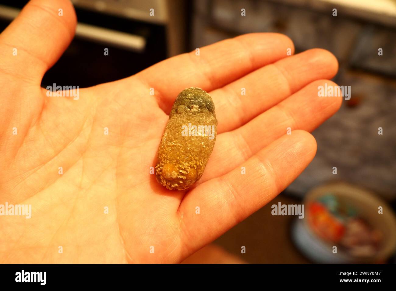 Gallstone disease, cholelithiasis - the formation of stones, stones in ...