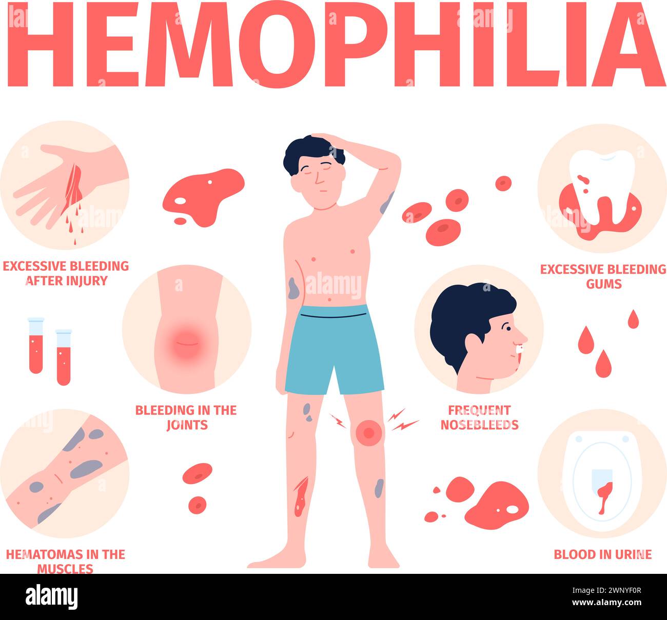 Hemophilia symptoms. Medical poster about men blood problems. Healthcare hospital info poster ...