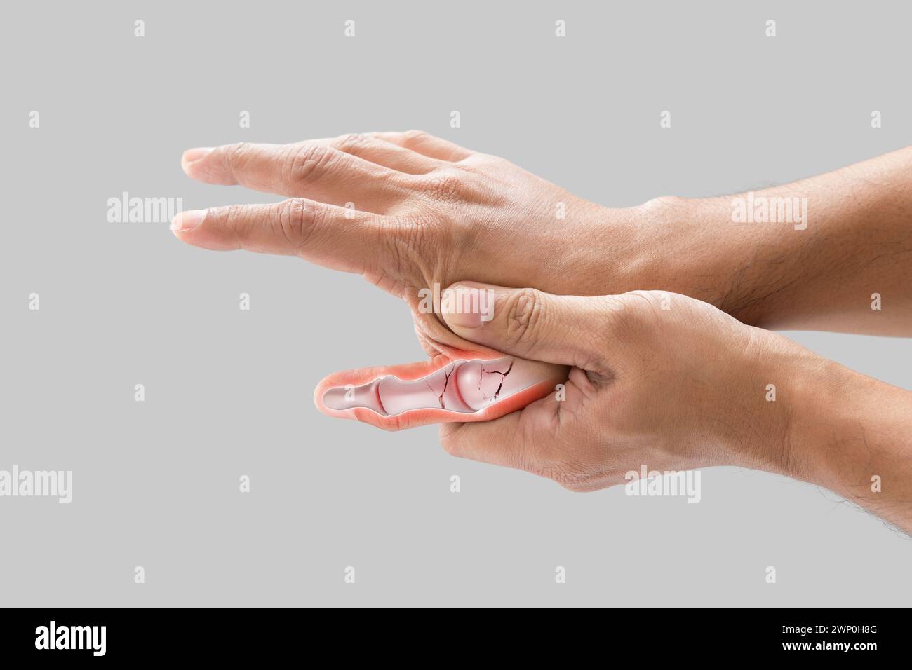 A man has a pain thumb because the bone was fractured in an accident ...