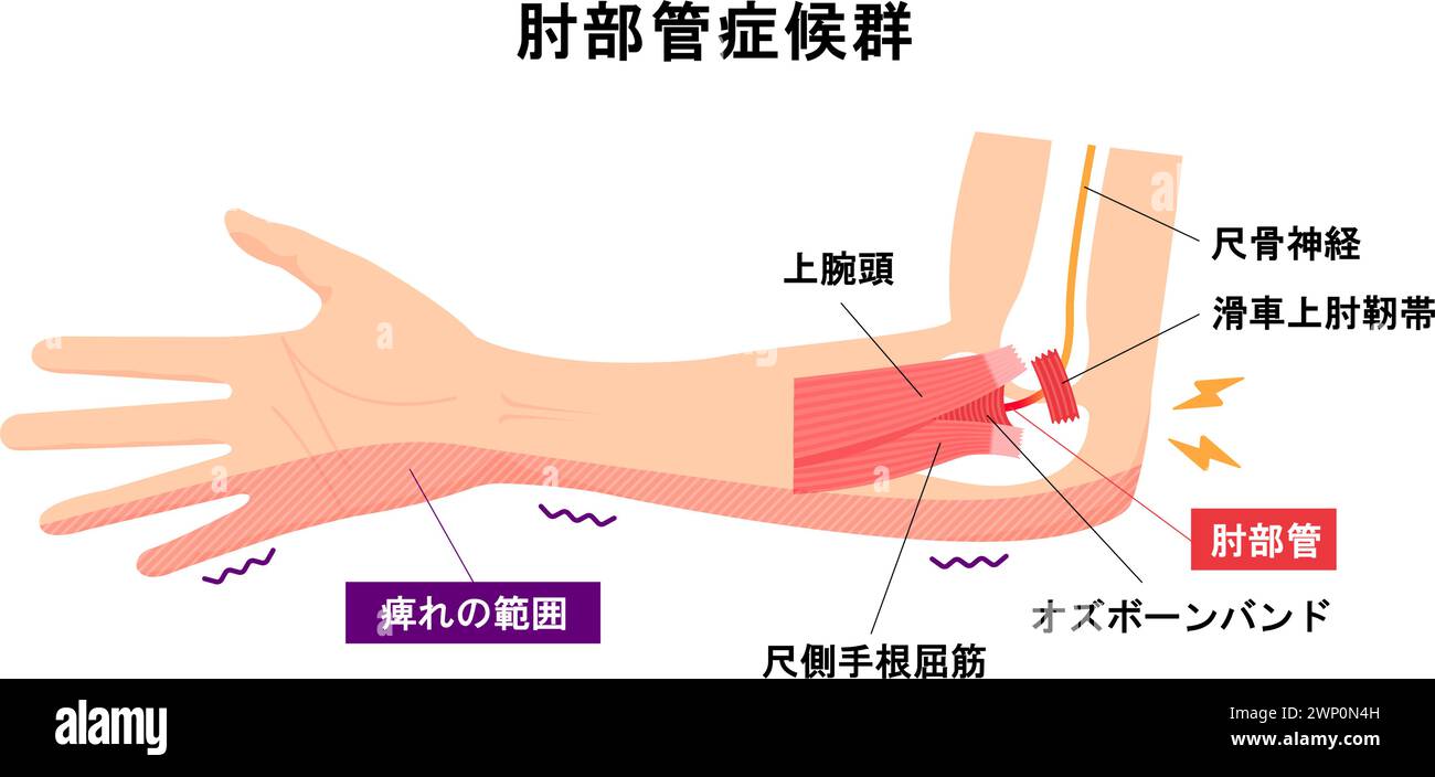 Cubital tunnel syndrome vector illustration Stock Vector Image & Art ...