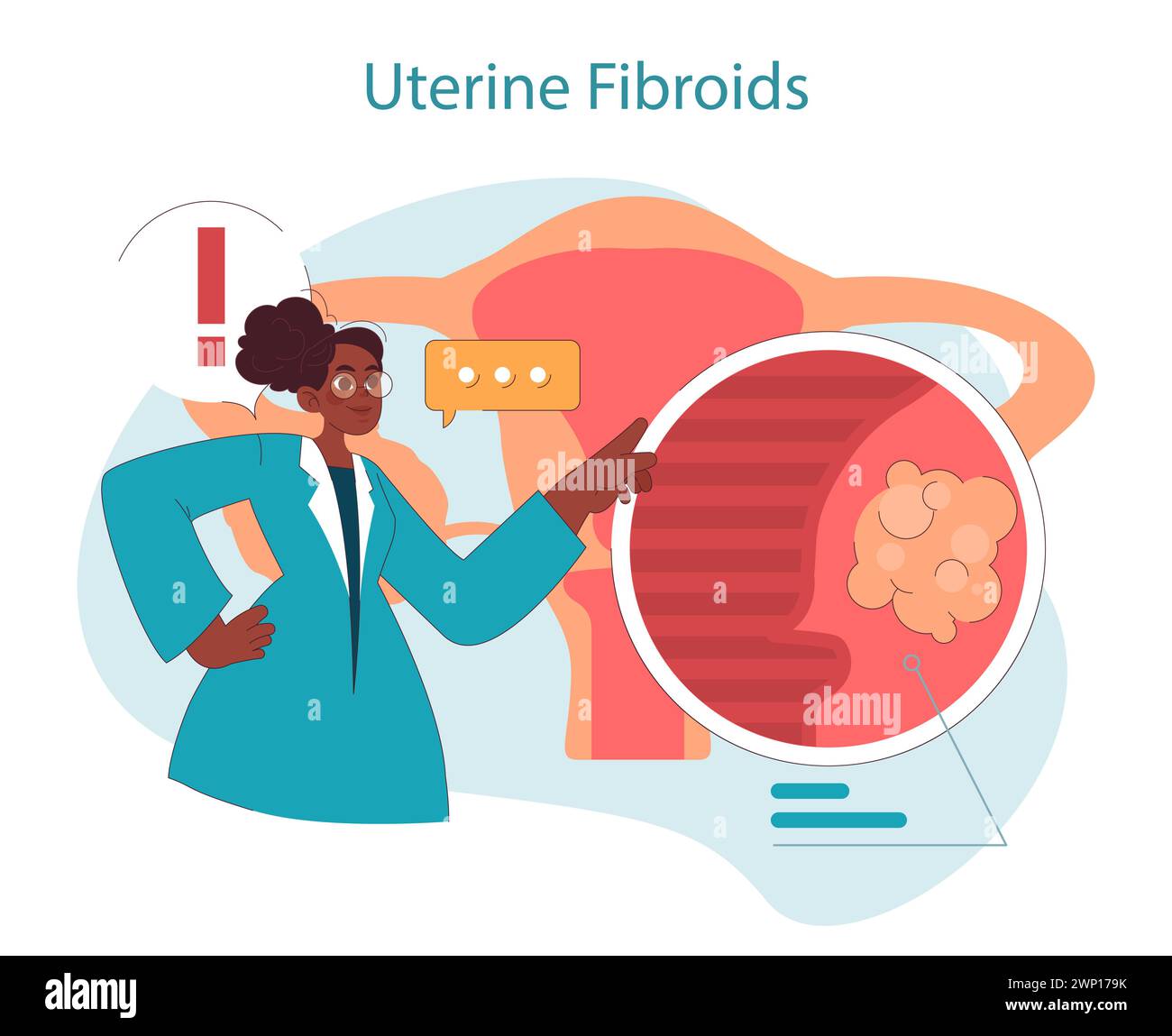 Uterine fibroids. Doctor illustrates uterine fibroids condition ...