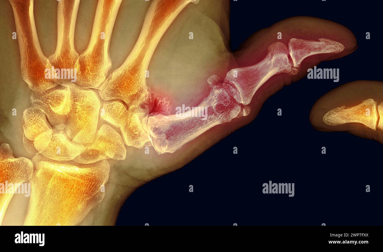 Osteoarthritis of the thumb, X-ray Stock Photo - Alamy