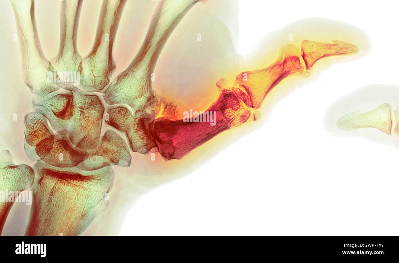 Osteoarthritis of the thumb, X-ray Stock Photo - Alamy