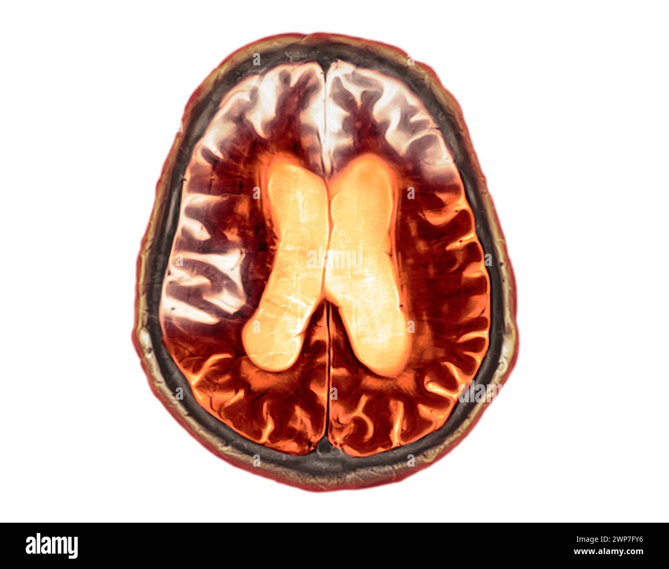 Frontotemporal dementia, MRI and CT scans Stock Photo - Alamy