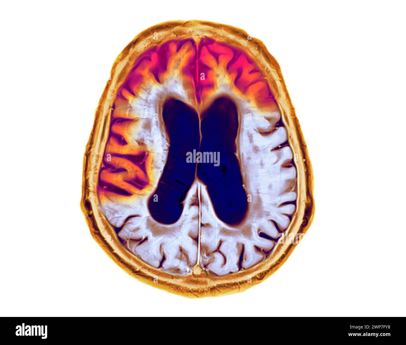 Frontotemporal dementia, MRI and CT scans Stock Photo - Alamy