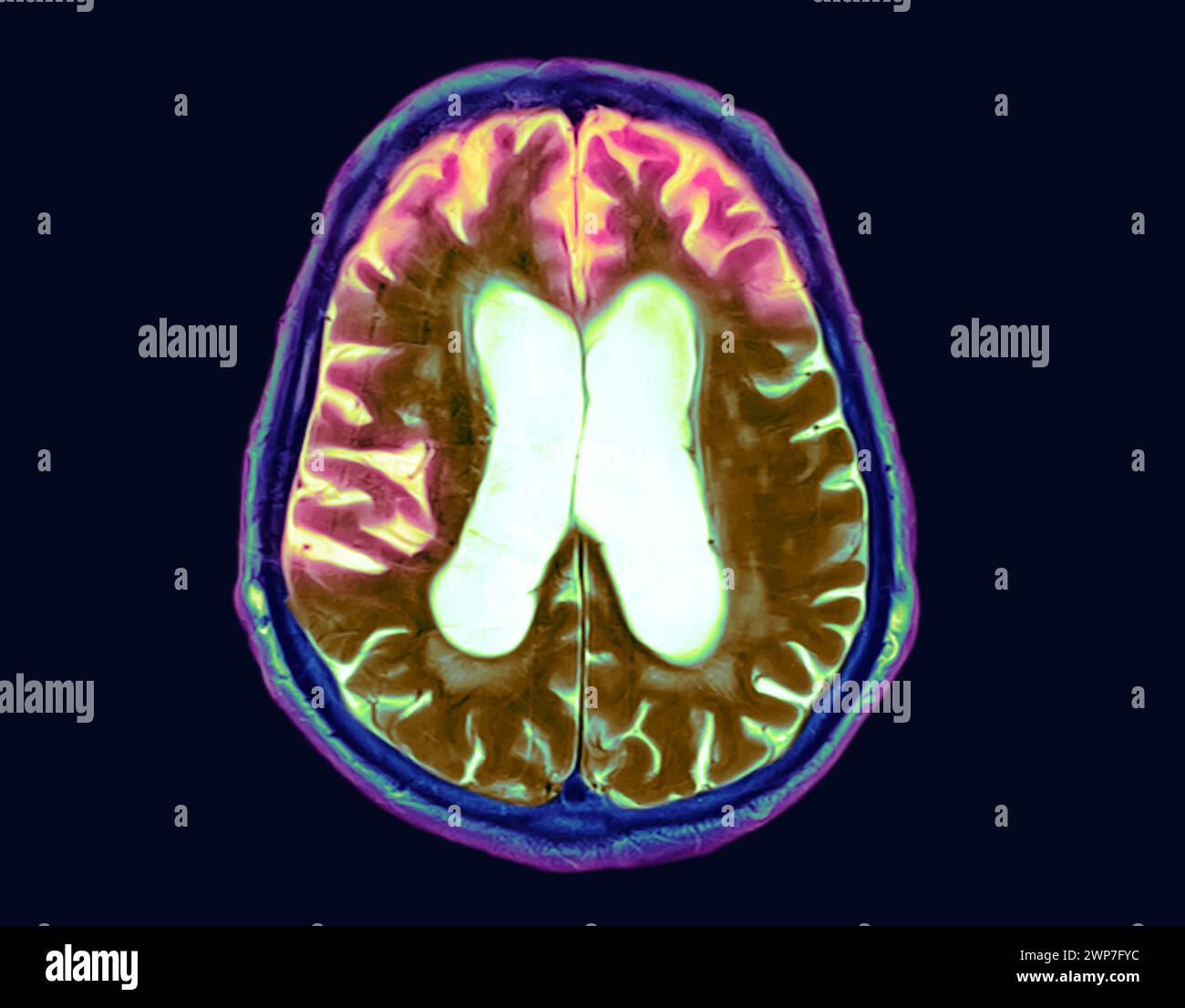 Frontotemporal dementia, MRI and CT scans Stock Photo - Alamy