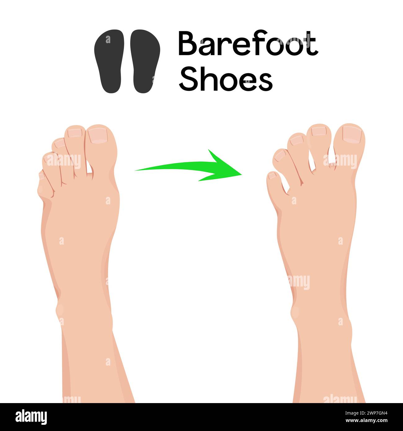 Compare feet before and after barefoot shoes vector illustration ...