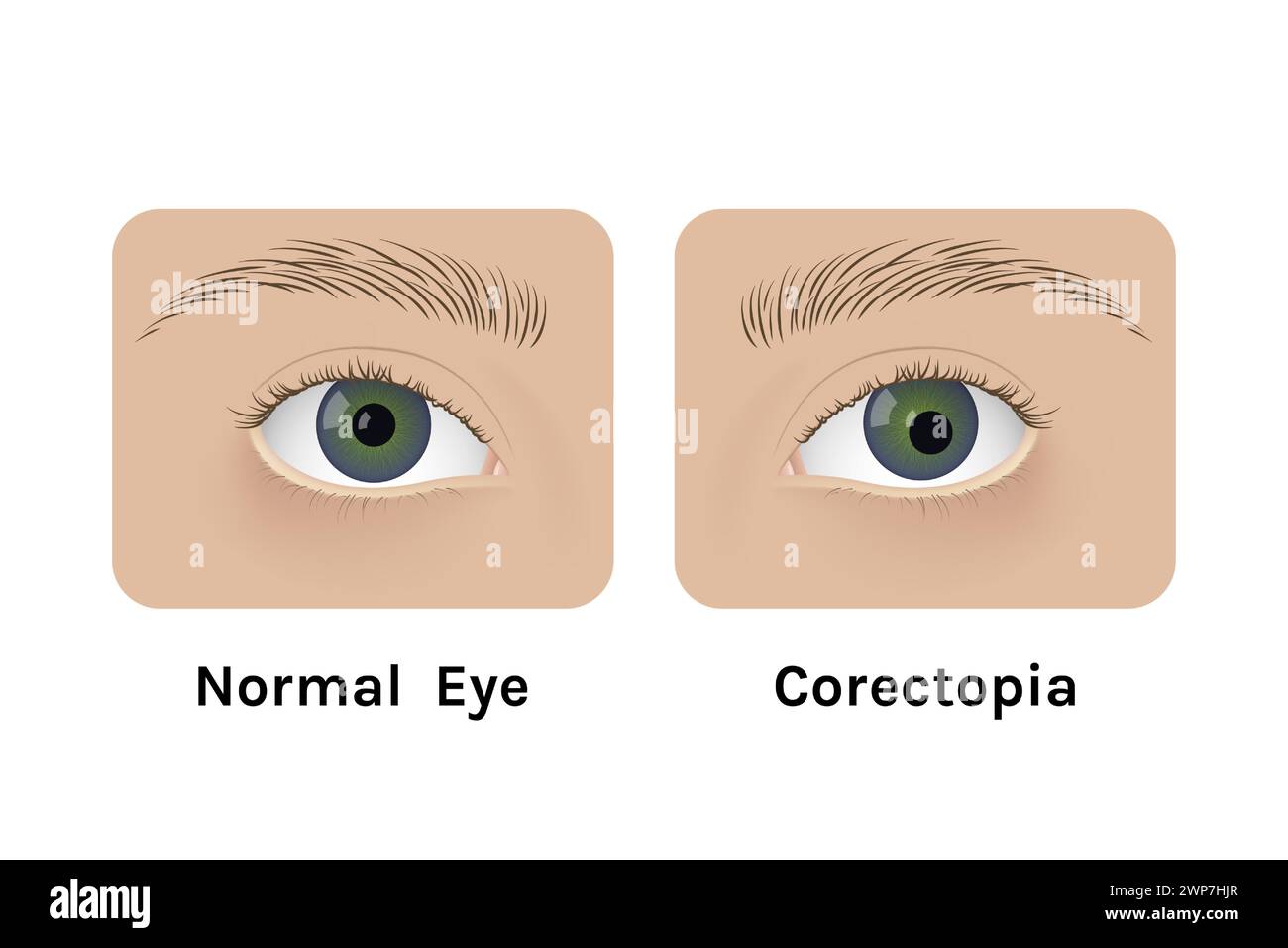 Realistic human normal eyes and with corectopia vector illustration ...