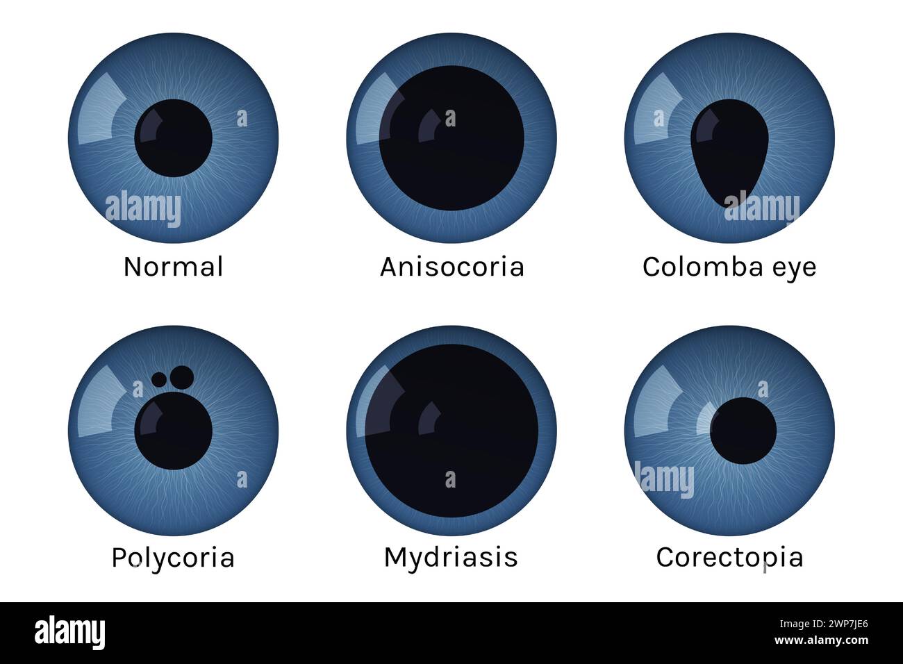 Eye pupils set with disease vector illustration. Normal, anisocoria, colomba, polycoria ...