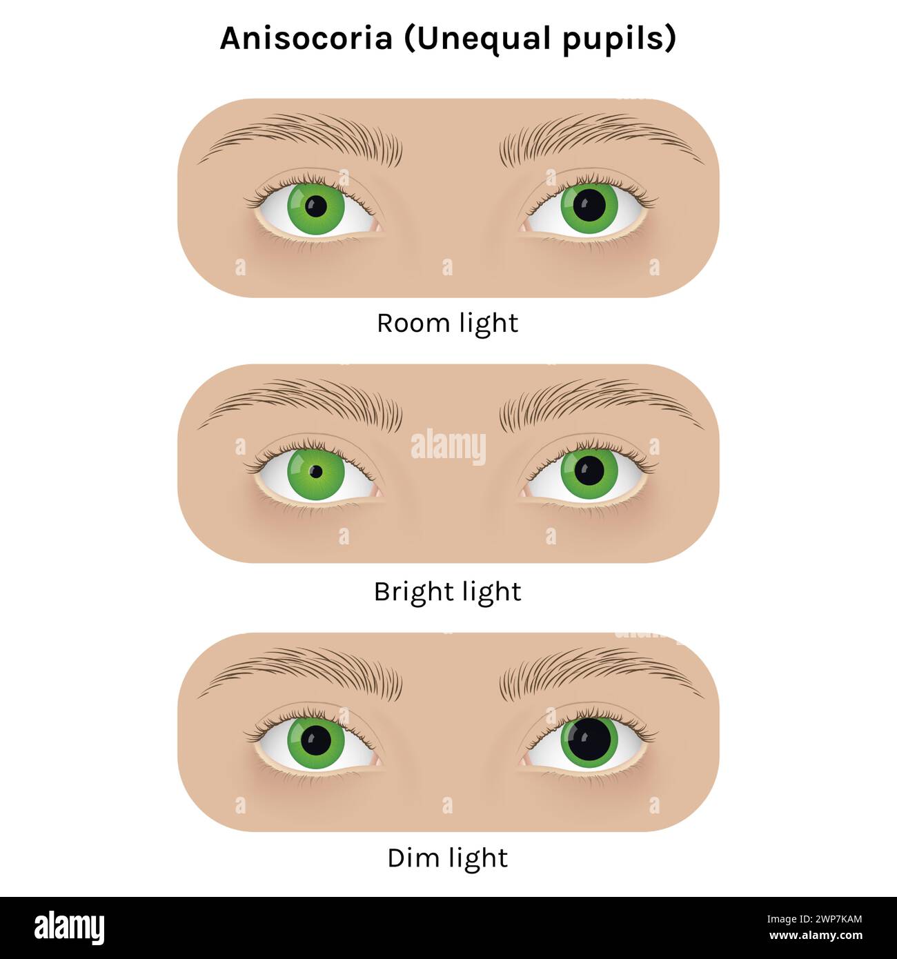 Realistic human eyes with anisocoria vector illustration design ...