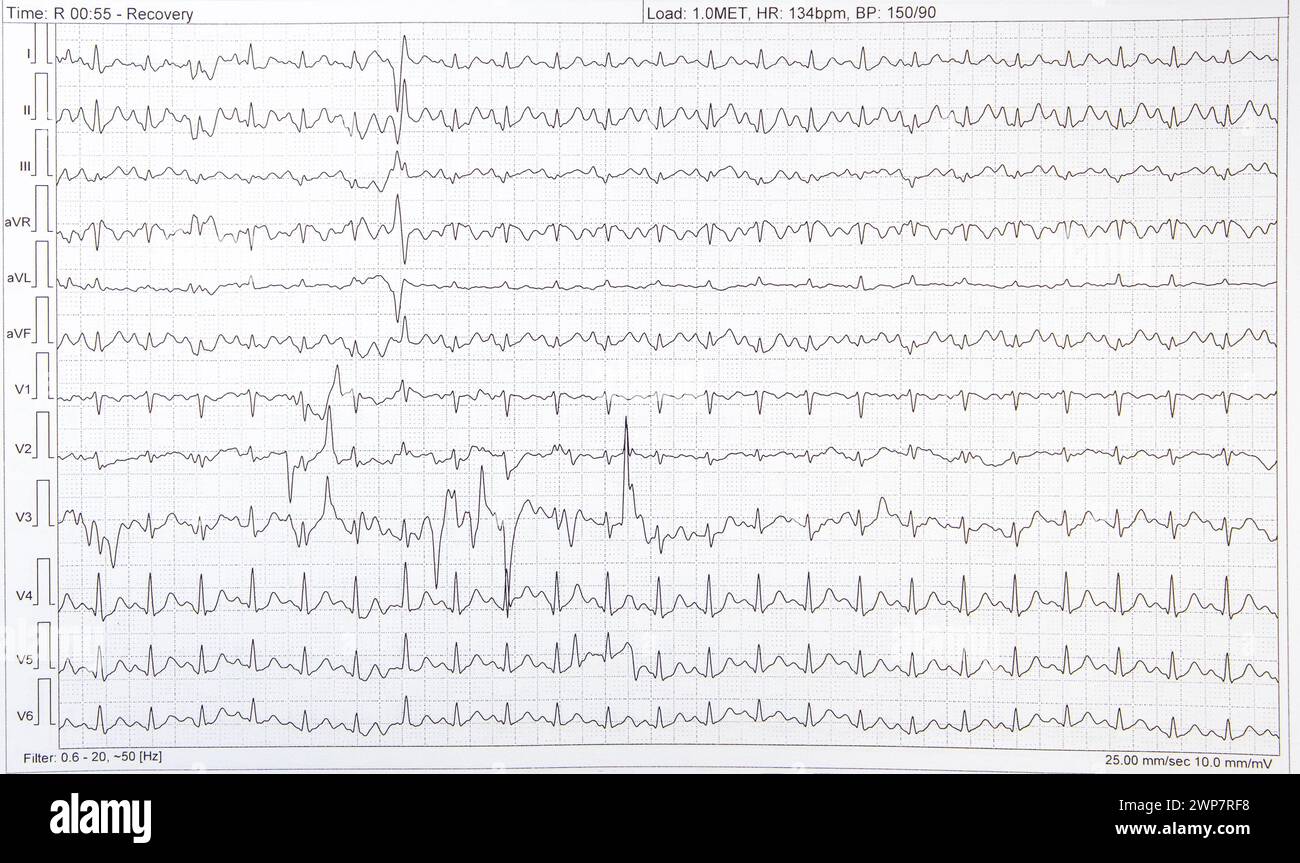 A graphic EKG electrocardiogram of a person with heart disease Stock ...