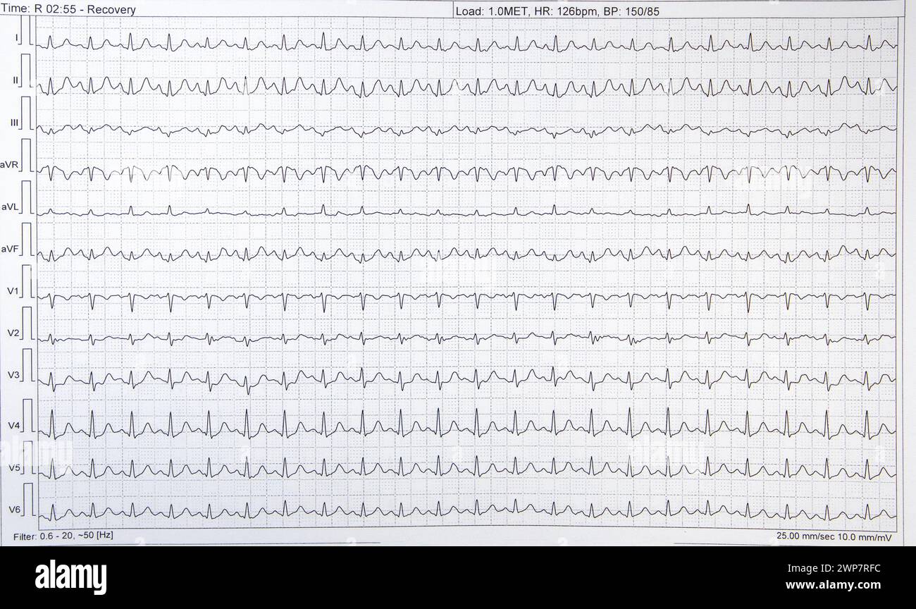 A graphic EKG electrocardiogram of a person with heart disease Stock ...